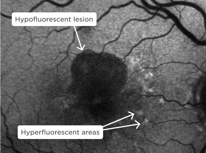 Assess Progression - Izervay