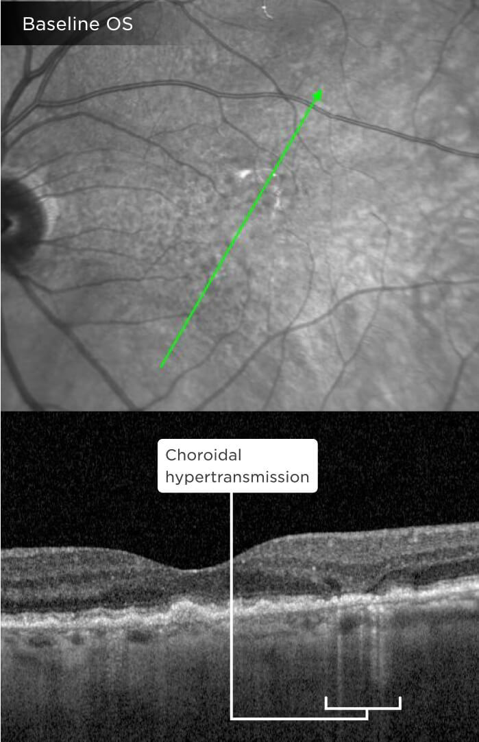 Assess Progression - Izervay