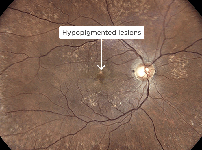 Assess Progression - Izervay